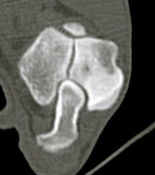 Update on humeral condylar fracture treatment in dogs