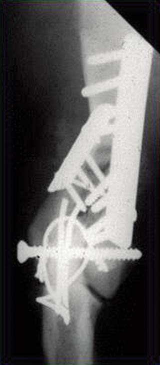 Update on humeral condylar fracture treatment in dogs