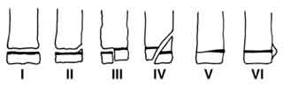 Physeal fractures in immature cats and dogs: part 1 – forelimbs