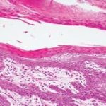 Superficial necrolytic dermatitis