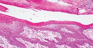 Superficial necrolytic dermatitis