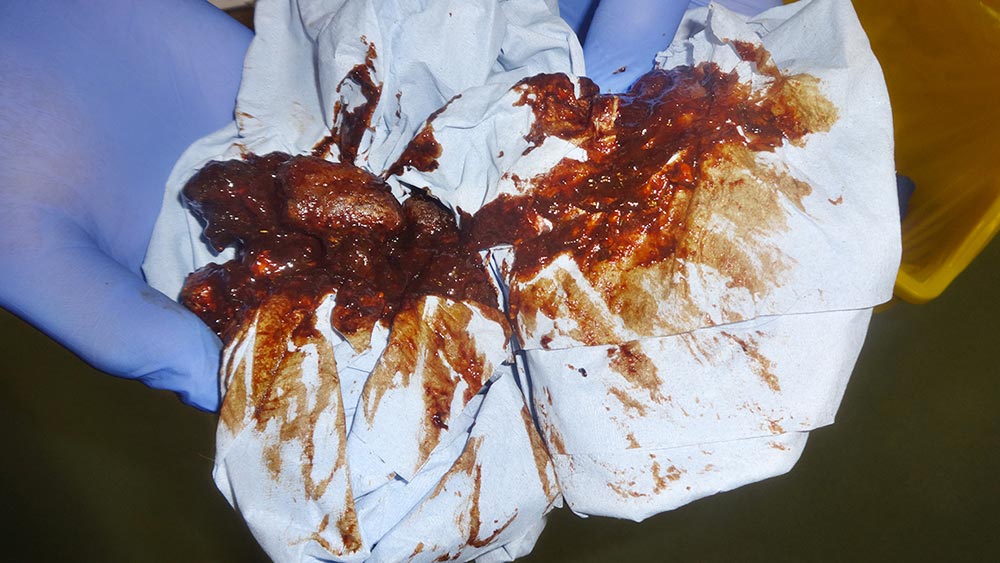 Inflammatory bowel disease – diagnosis and treatment