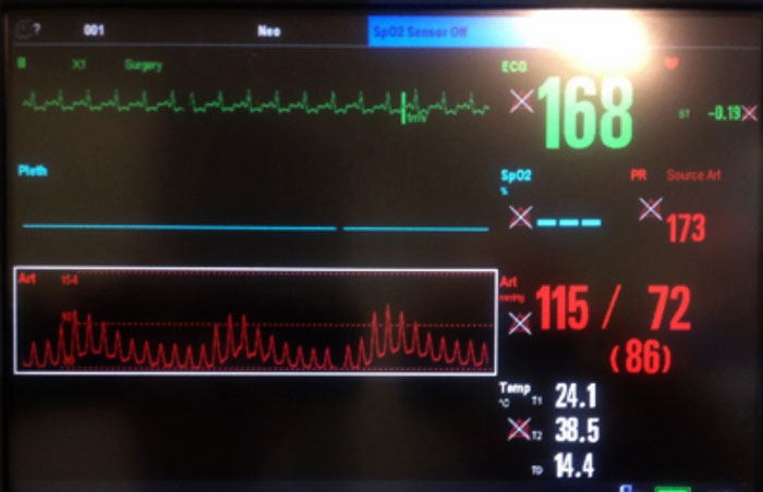 Heart disease patients: anaesthetic care and monitoring