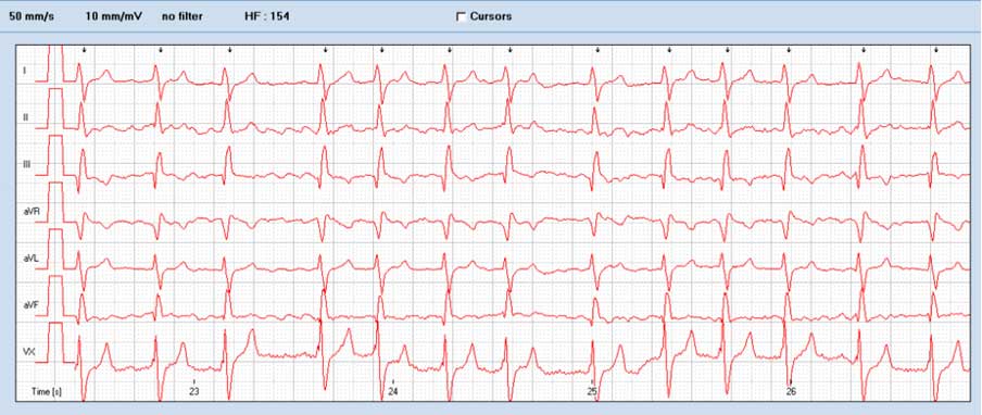 Heart disease in dogs