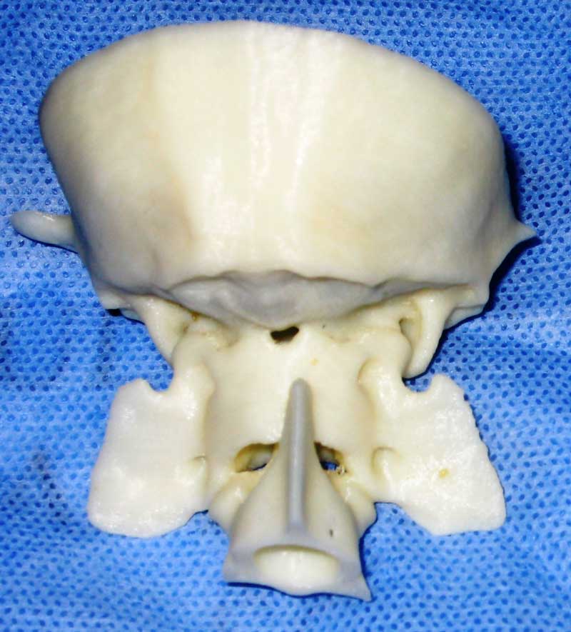 Cranioplasty for treating caudal occipital malformation syndrome