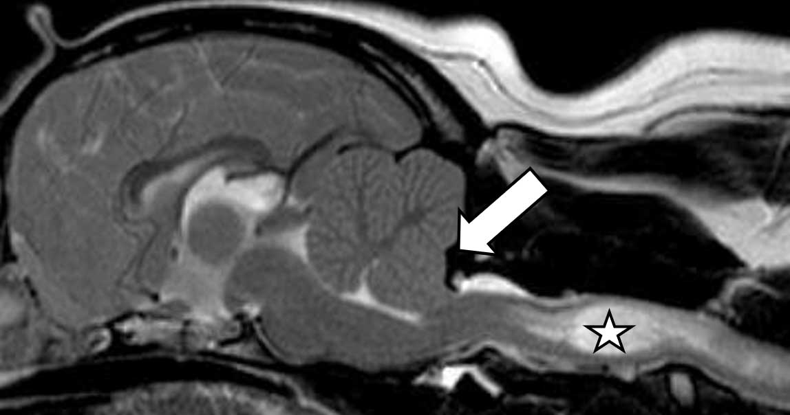 Cranioplasty for treating caudal occipital malformation syndrome