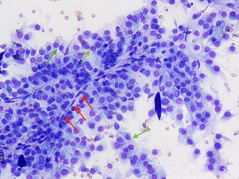 Cytology findings from a leg skin mass in a dog