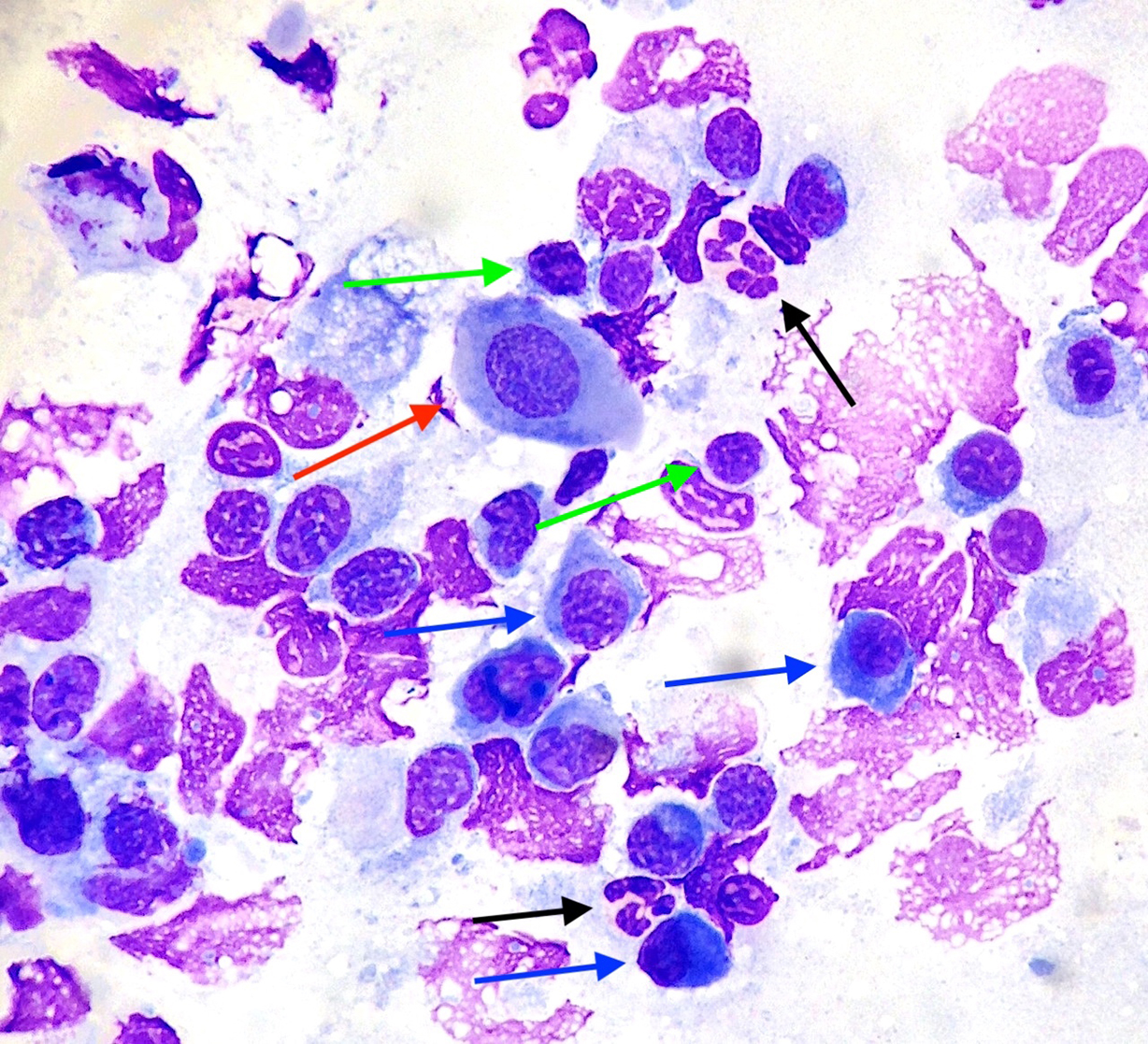 Cytology findings from bilateral corneal lesions in a canine patient