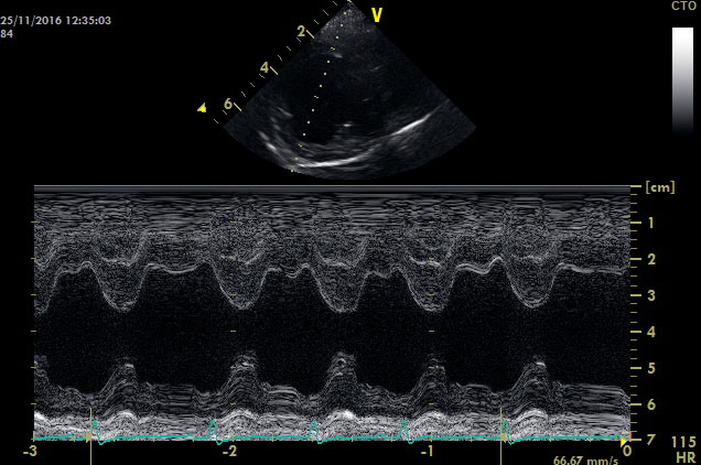 Chronic left-sided congestive heart failure: causes and care
