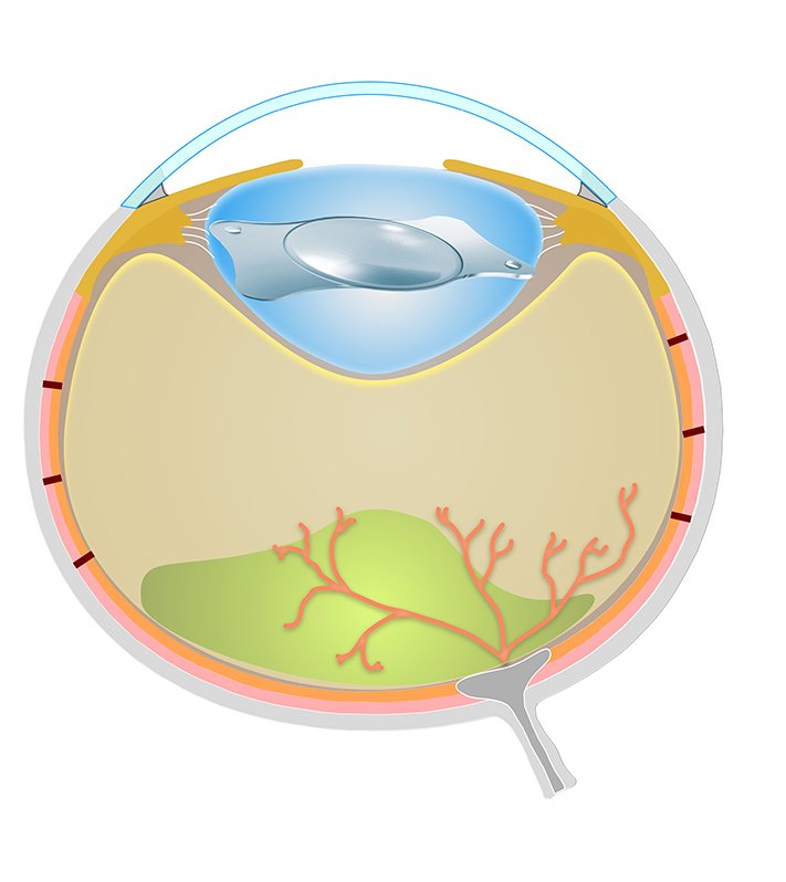 Canine retinal reattachment surgery – restoring vision